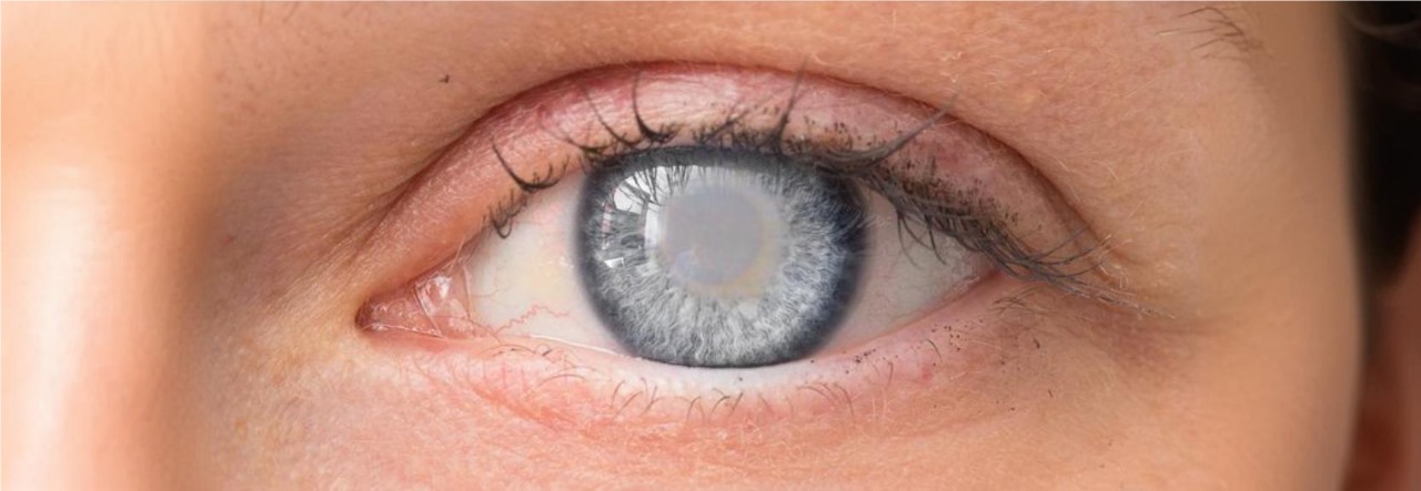 Rare Types of Cataracts (WIP) - SA Eye Specialists | Adelaide ...