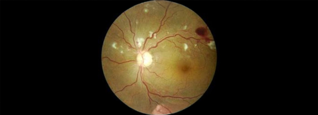 High Blood Pressure & Your Eyes: The Silent Link You Shouldn’t Ignore ...